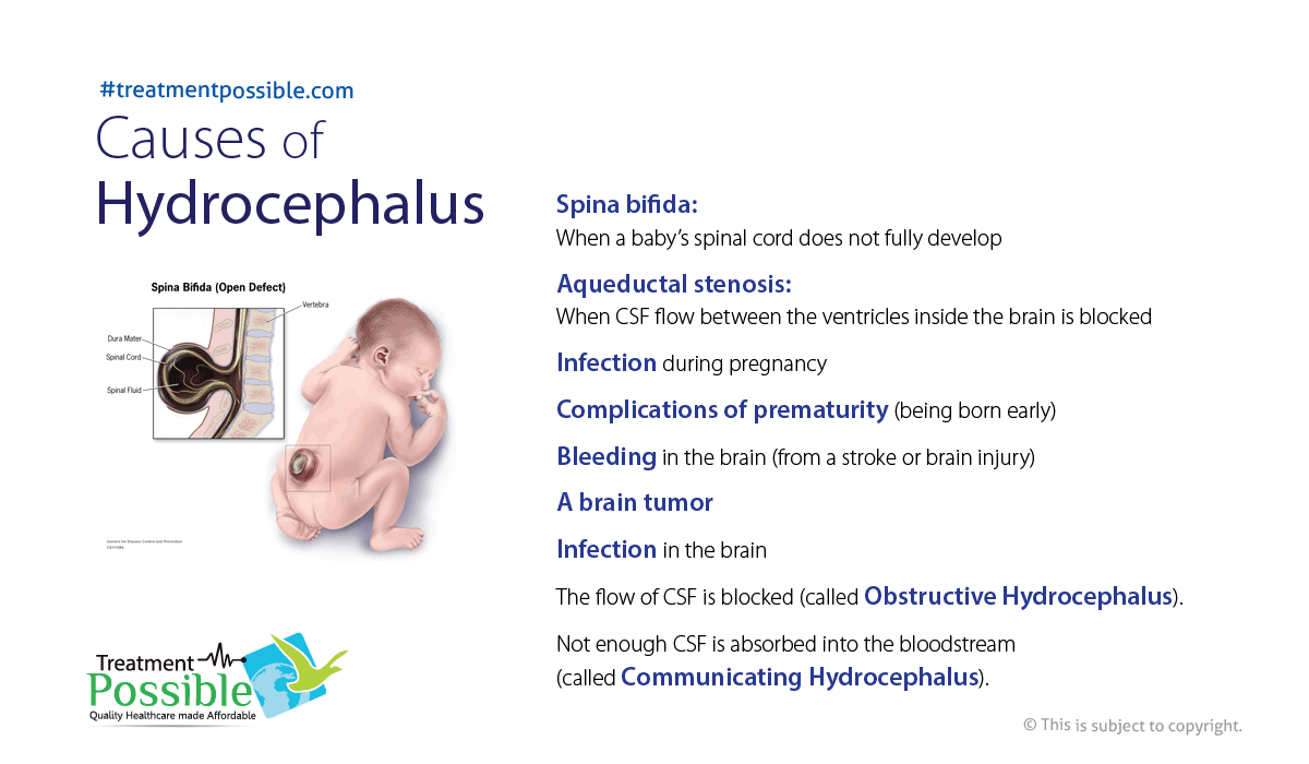 Hydrocephalus Surgery | Treatment Possible